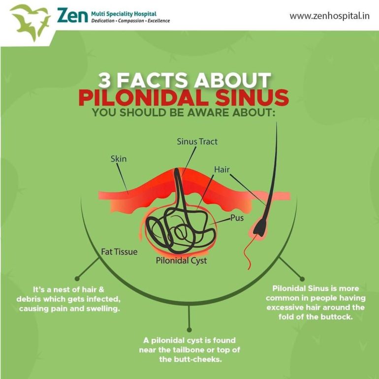 Pilonidal Sinus Zen Multi Speciality Hospital